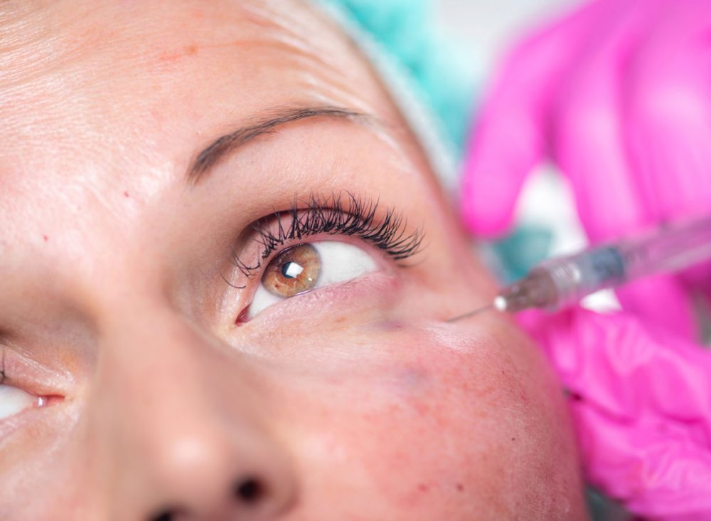 Best Radiesse® Injections in Los Angeles and West Hollywood